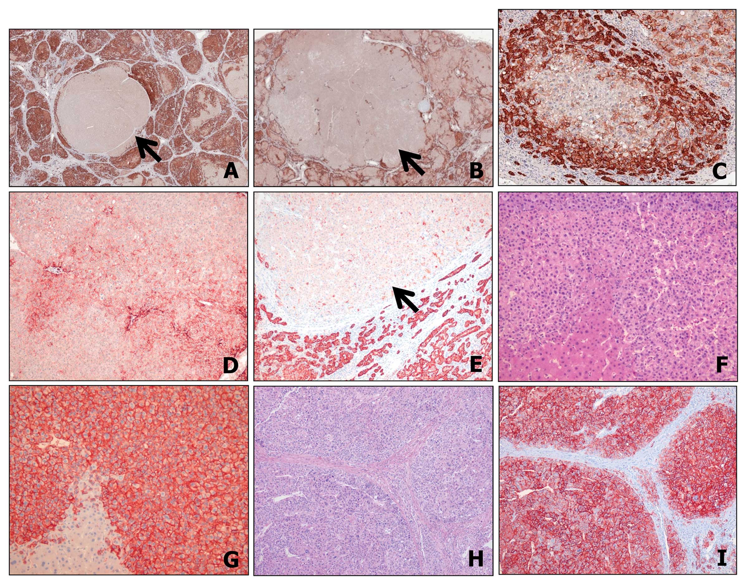 Icd 10 Code For Epiretinal Membrane Os