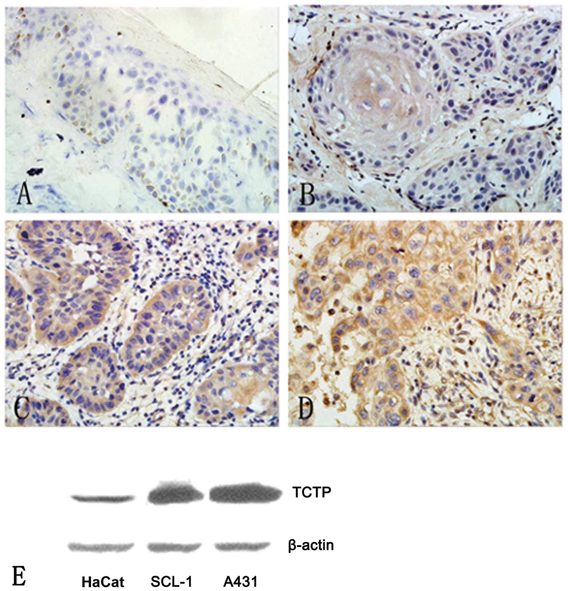 Upregulation of TCTP expression in human skin squamous cell carcinoma ...