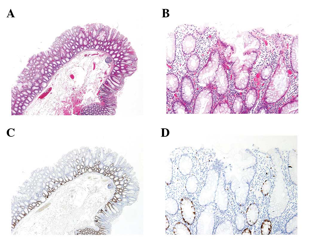 Sessile Polyp Histology