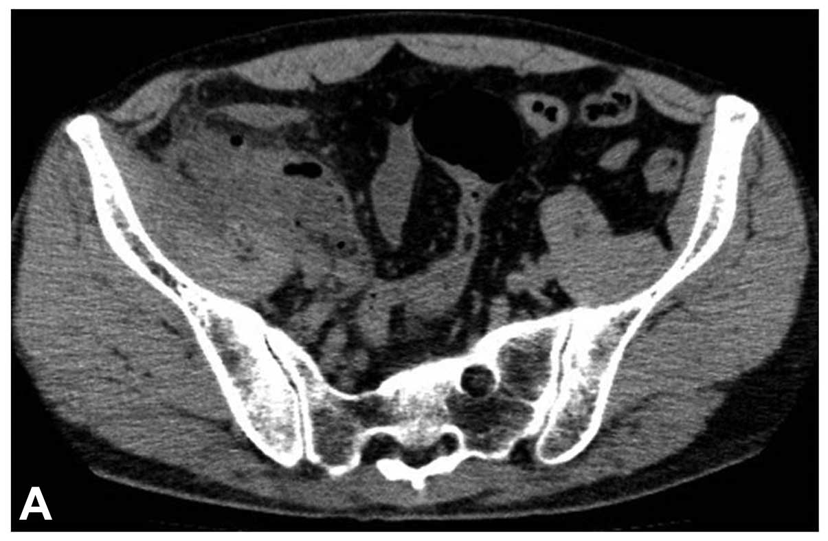 Retroperitoneal Abscess
