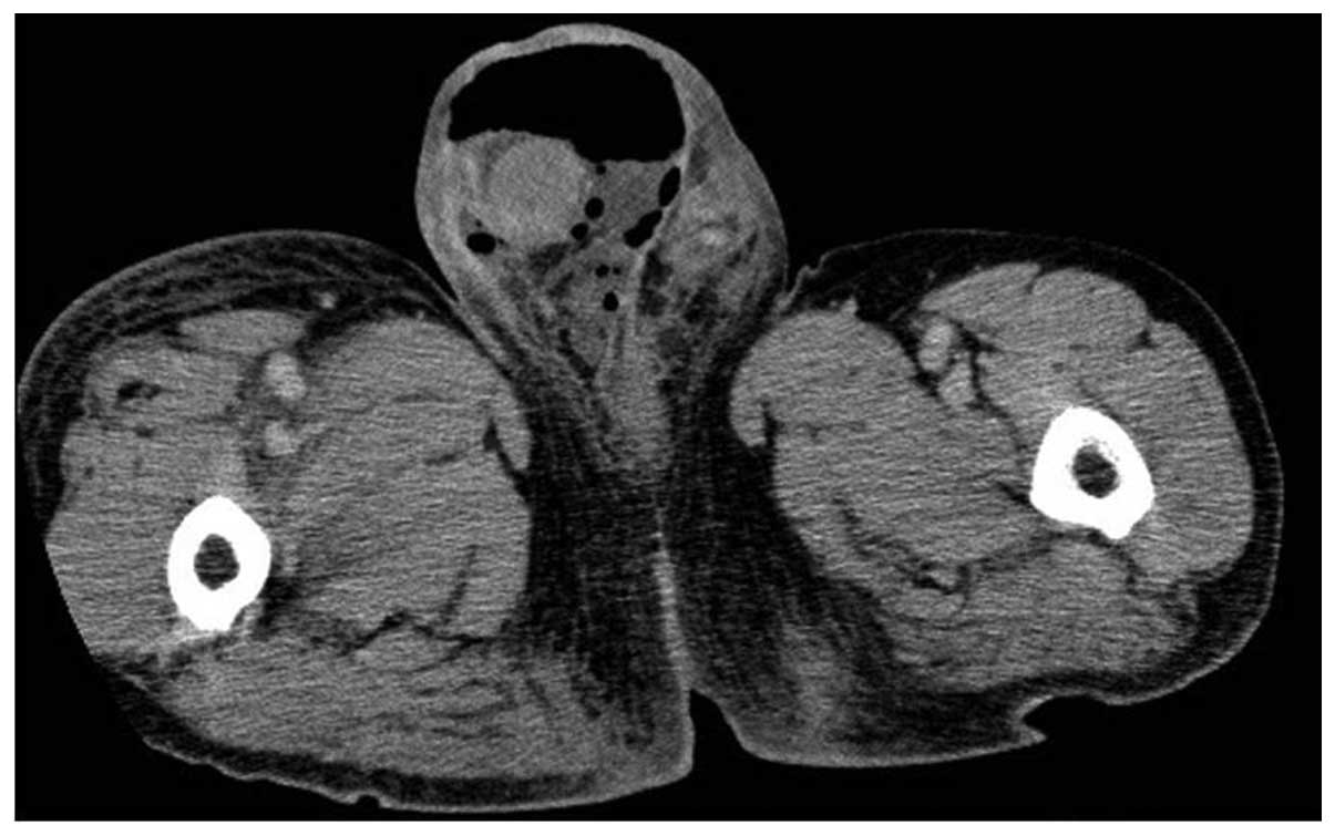 Retroperitoneal abscess shortly after chemotherapy for lung cancer: A ...