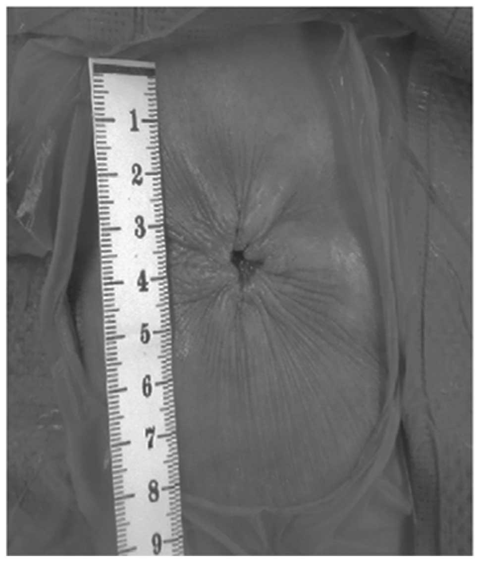 loop colostomy closure