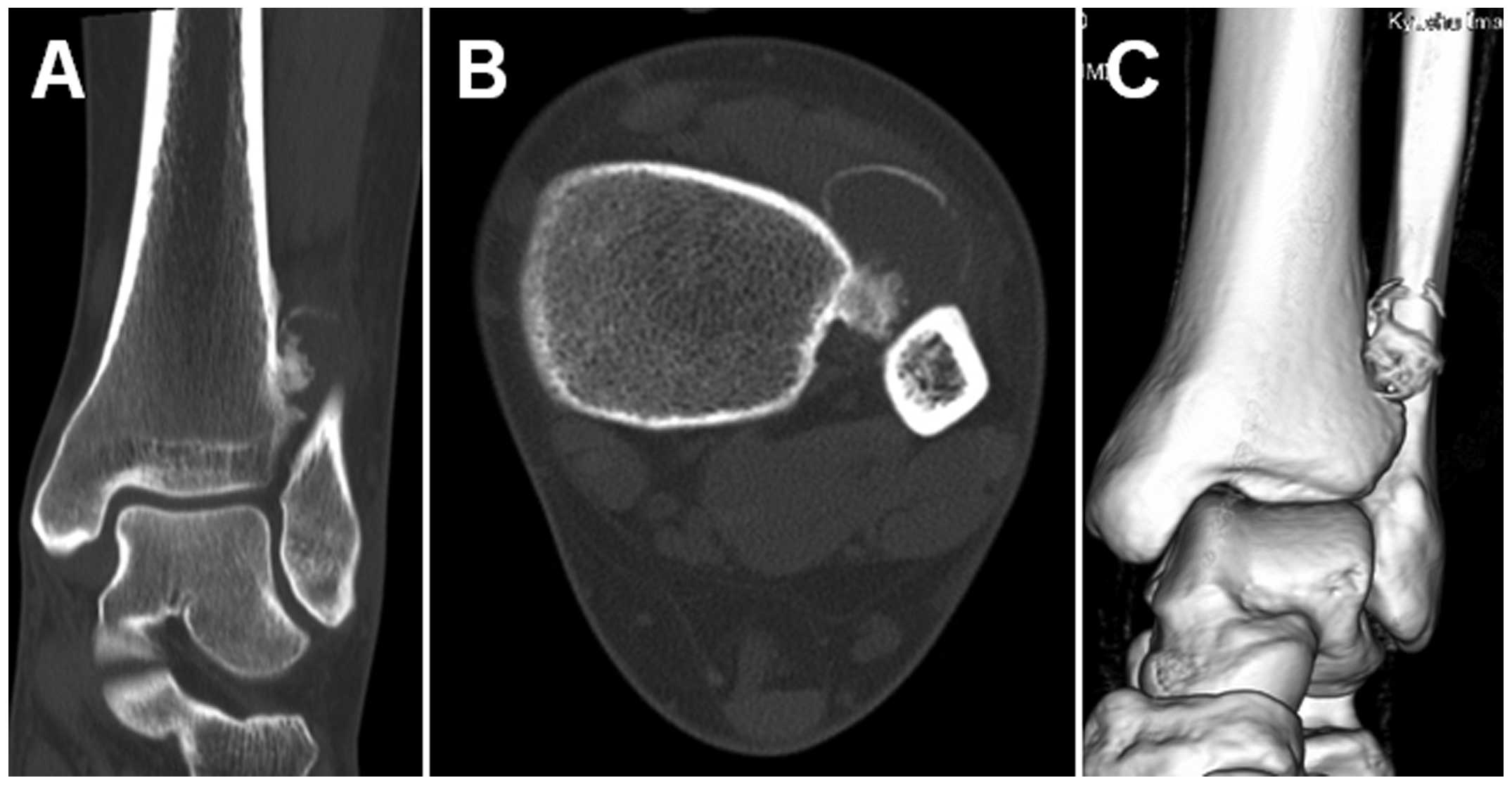 Periosteal chondroma of the distal tibia: Computed tomography and ...