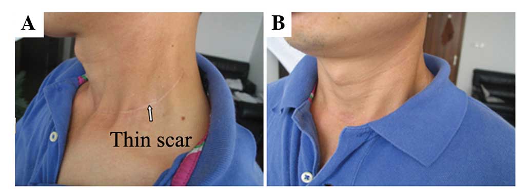 Application of a cervical low incision in the functional neck ...