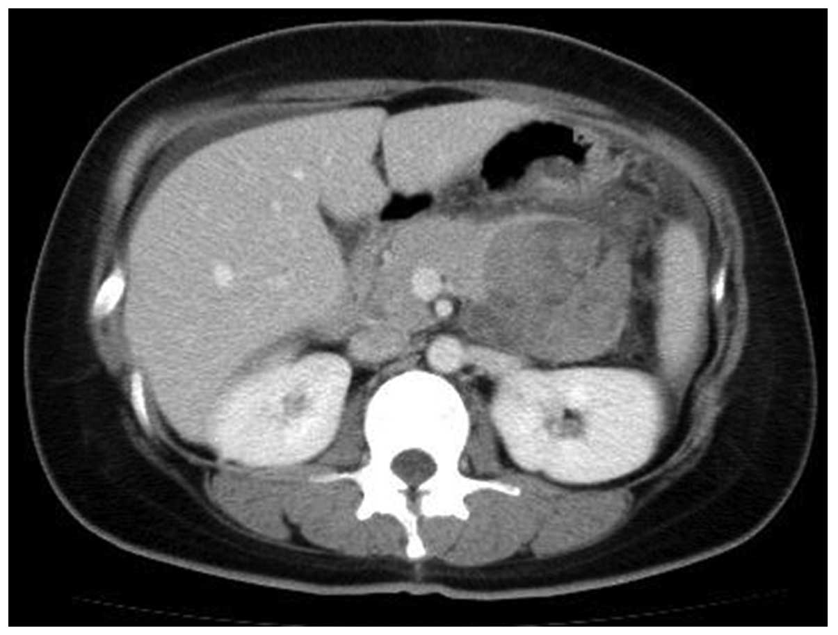 Mucinous cystadenocarcinoma of the pancreas with anaplastic carcinoma ...