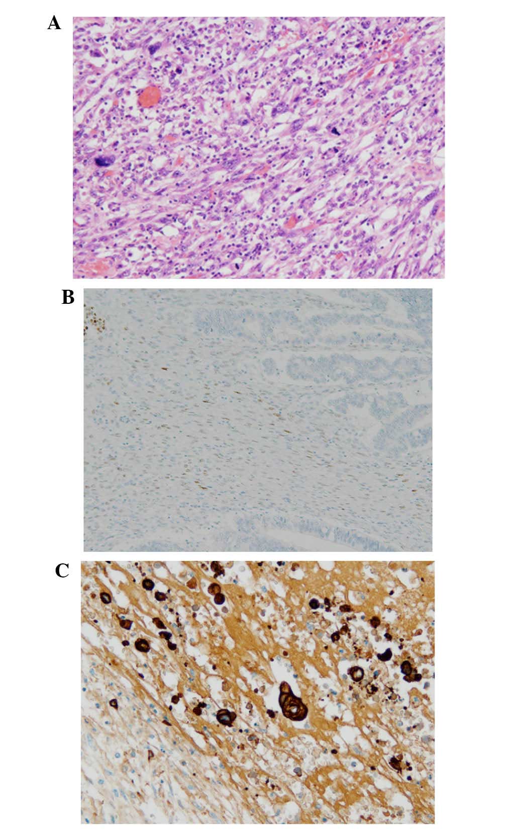 Mucinous cystadenocarcinoma of the pancreas with anaplastic carcinoma ...