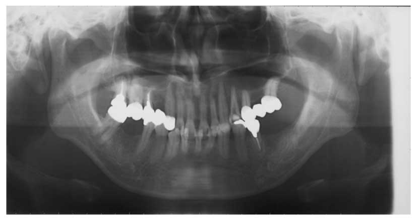 Maxillary And Jaw Lesions