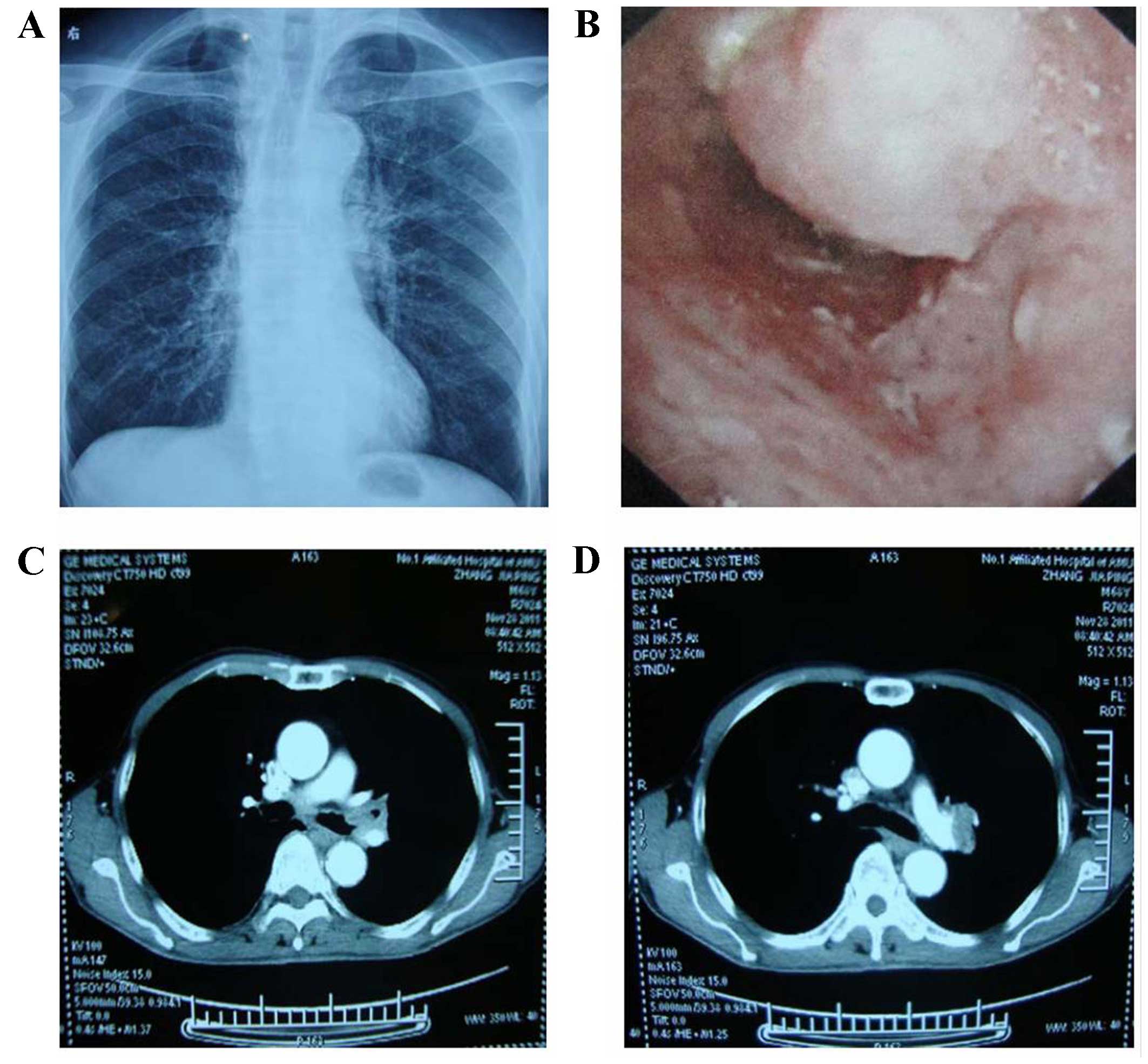 Video-assisted thoracoscopic surgery for the central bronchogenic ...