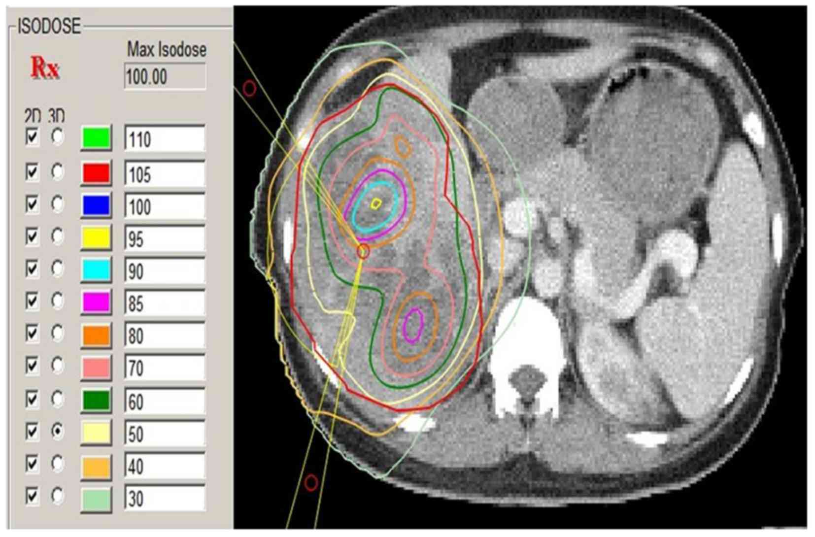 Curative effect of stereotactic body radiotherapy for unresectable ...