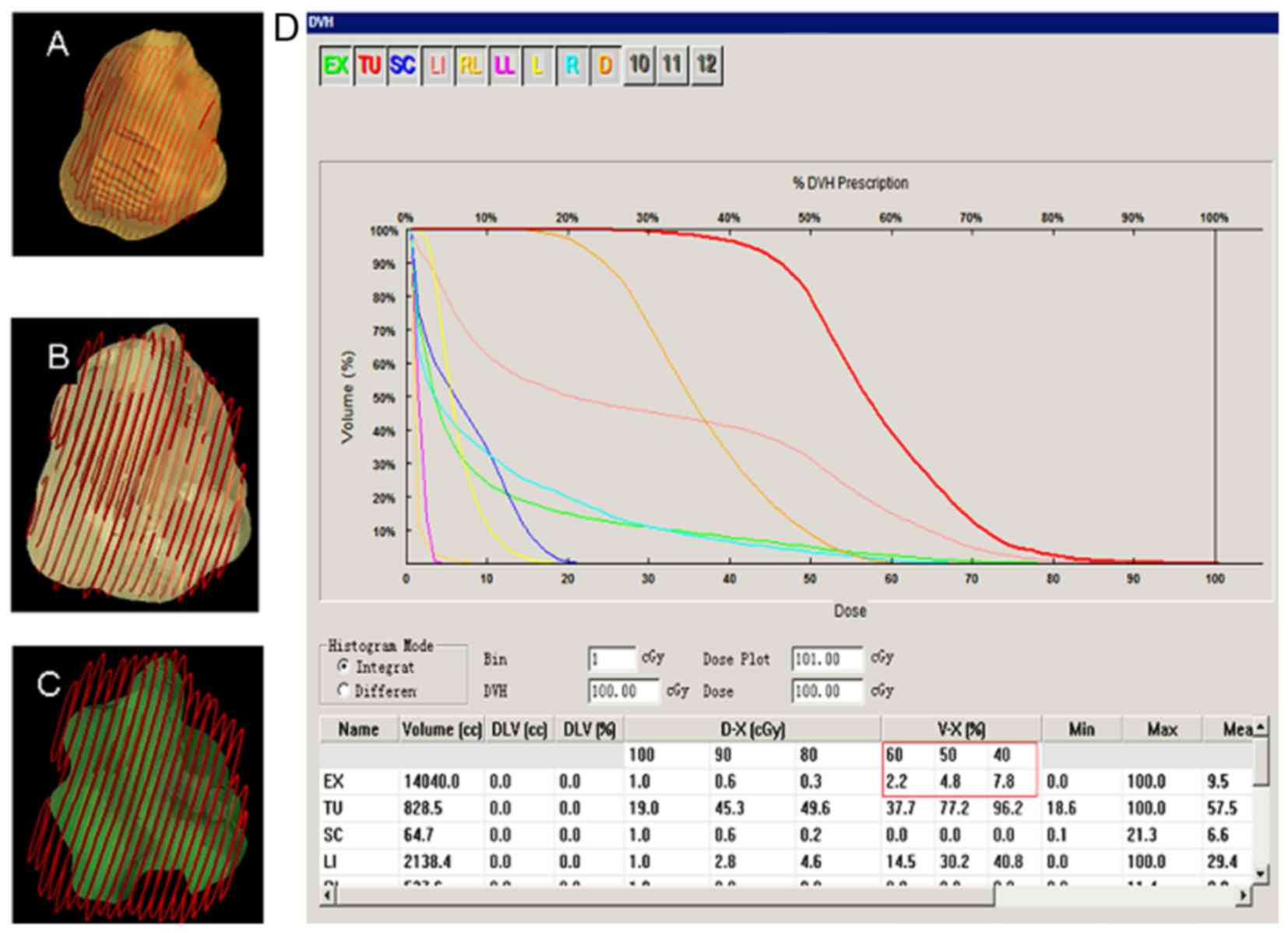 Curative effect of stereotactic body radiotherapy for unresectable ...