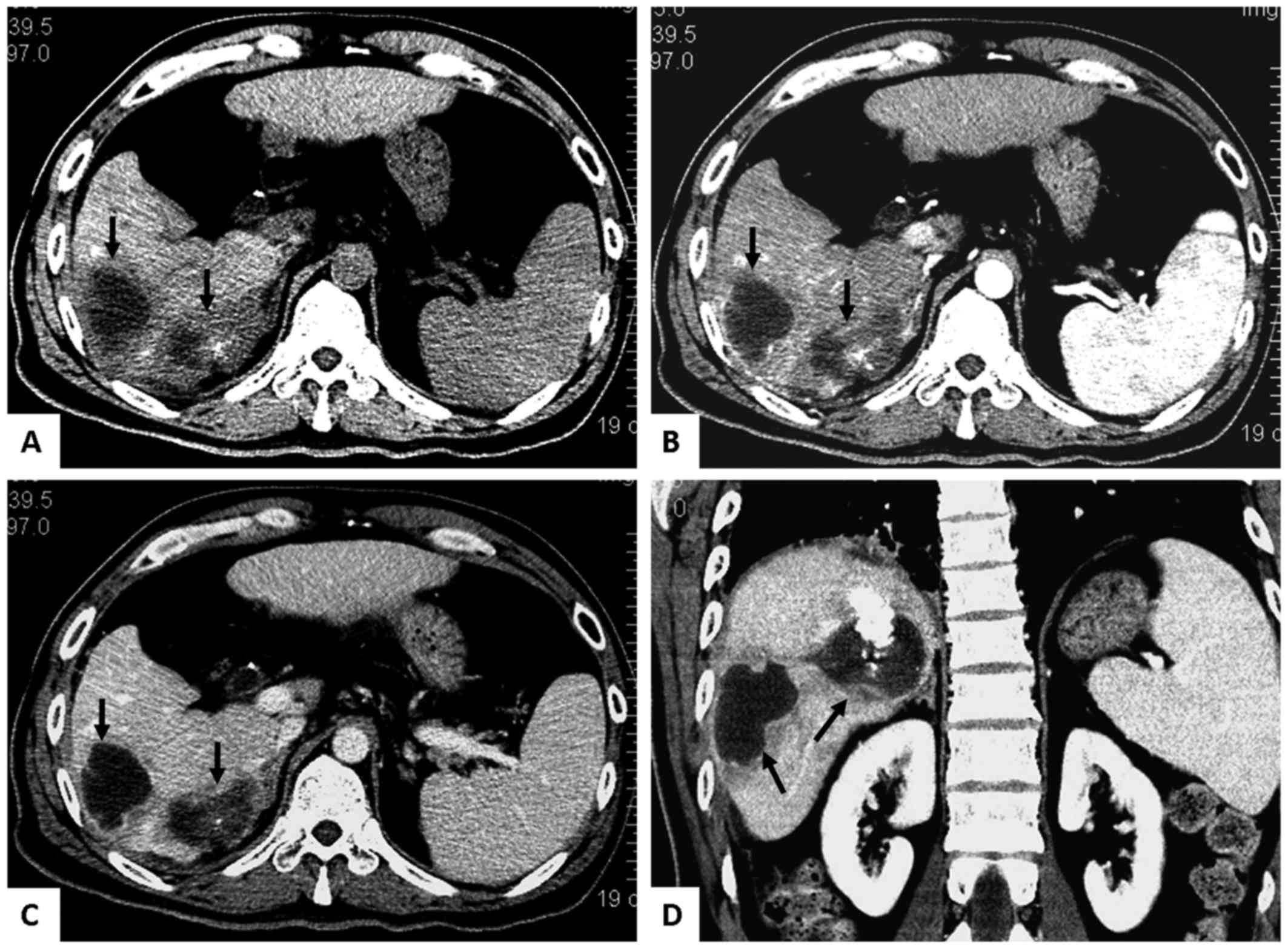 Intrahepatic biloma following transcatheter arterial chemoembolization ...