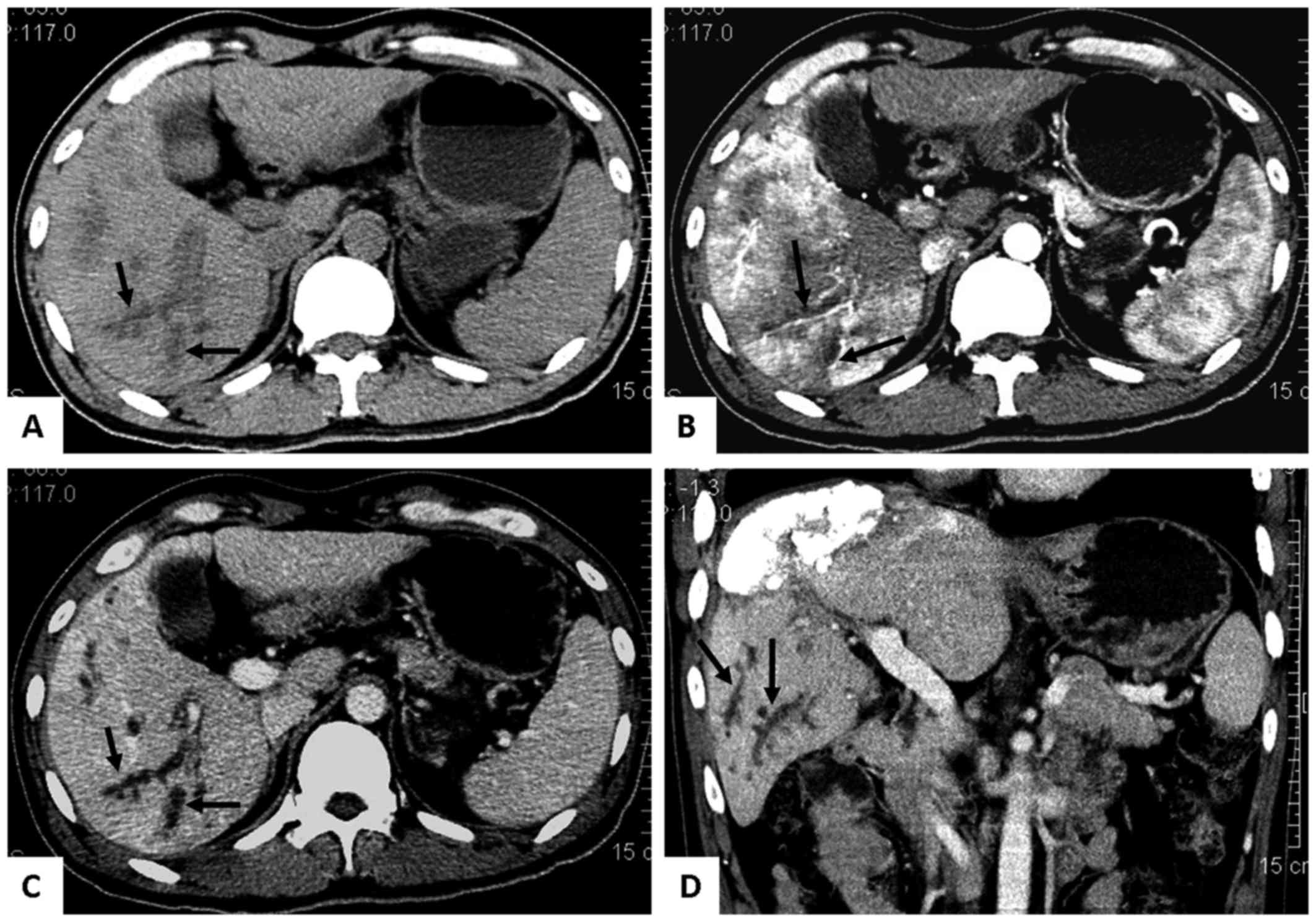 Intrahepatic biloma following transcatheter arterial chemoembolization ...