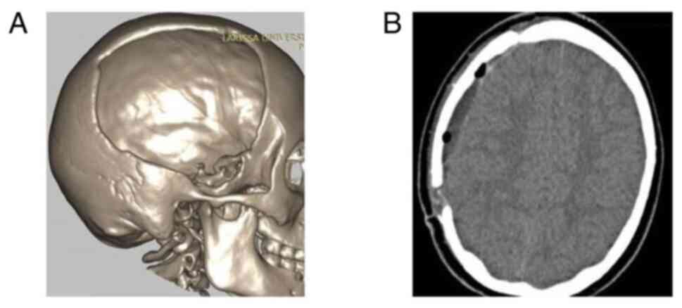 Bone graft absorption complication following cranioplasty: A ...