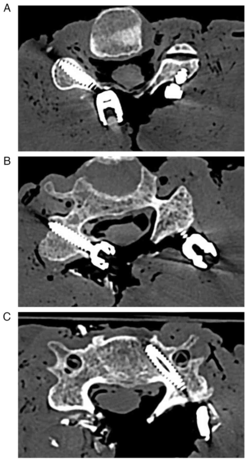 The Attallah screw: Where safety meets robustness in posterior subaxial ...