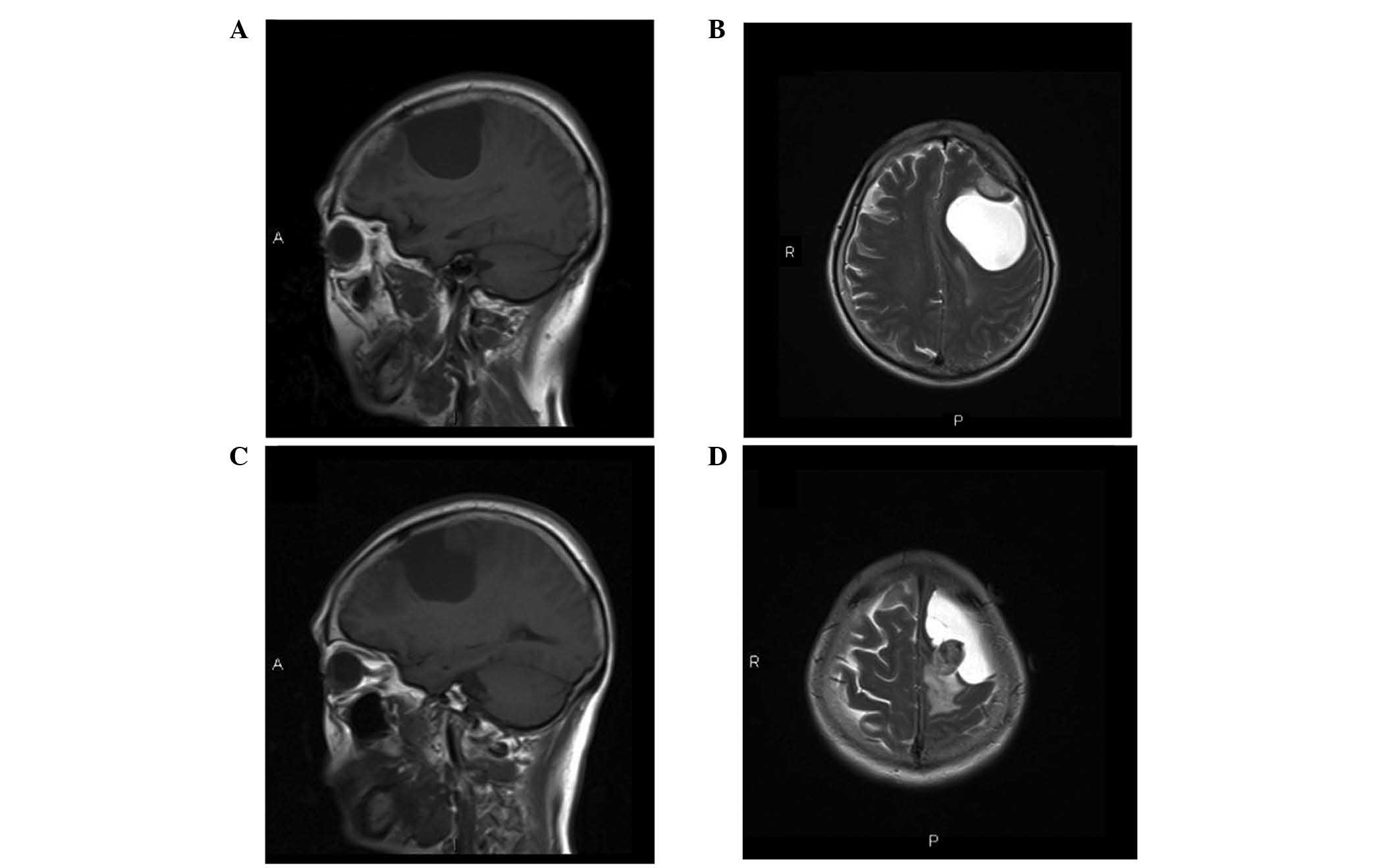 A Solitary Fibrous Tumor With Concurrent Meningioma At The Same Site A A Solitary Fibrous Tumor With Concurrent Meningioma At The Same Site A