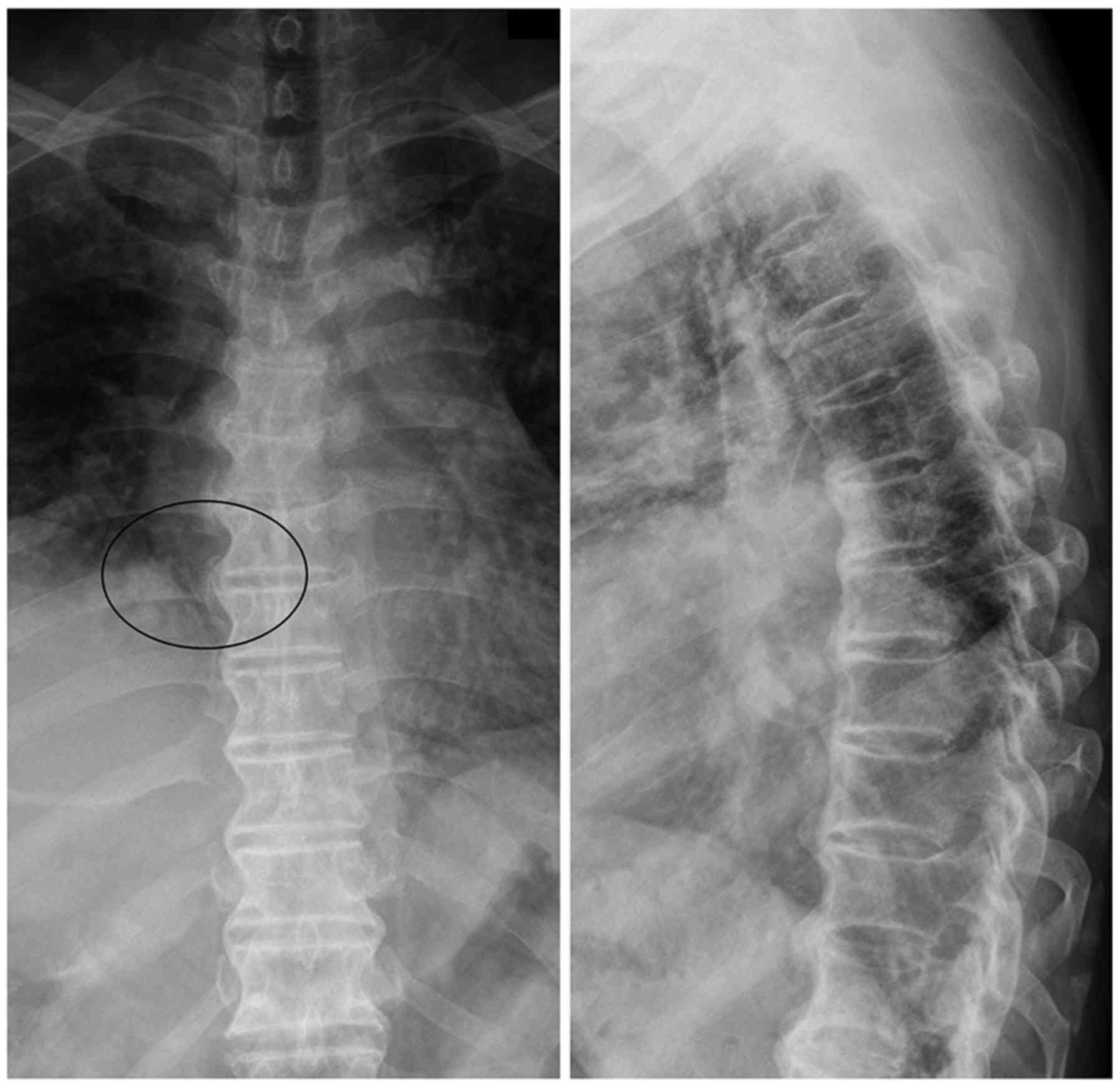 Lesion Lumbar Lesion Lumbar