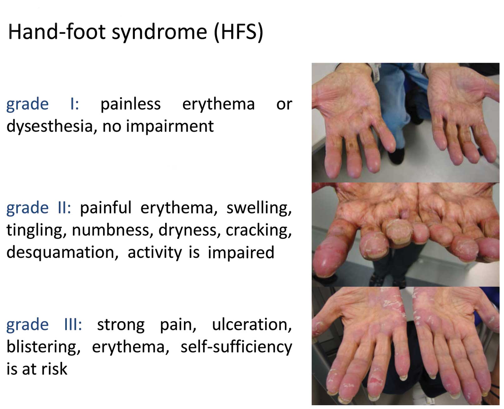 Hand Foot Syndrome Grading Scale