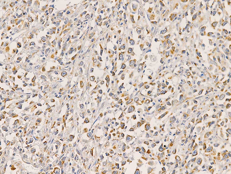 Lymphangiogenesis in non-Hodgkin's lymphoma and its correlation with ...
