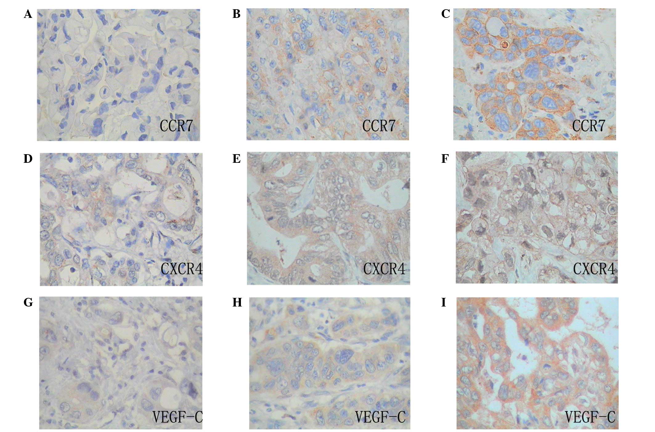 Effect of CCR7, CXCR4 and VEGF‑C on the lymph node metastasis of human pancreatic ductal ...