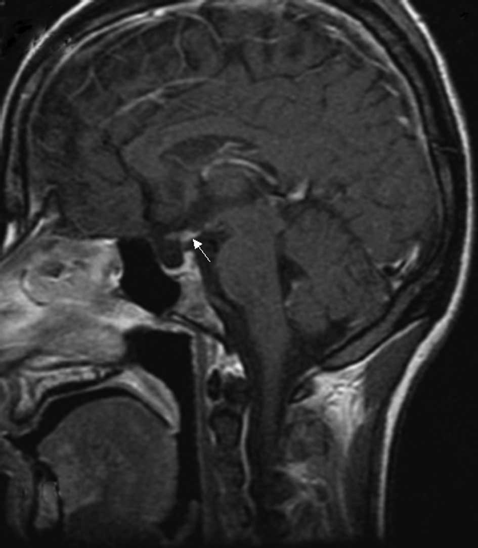 Clinical features of patients with non‑Hodgkin's lymphoma metastasizing ...