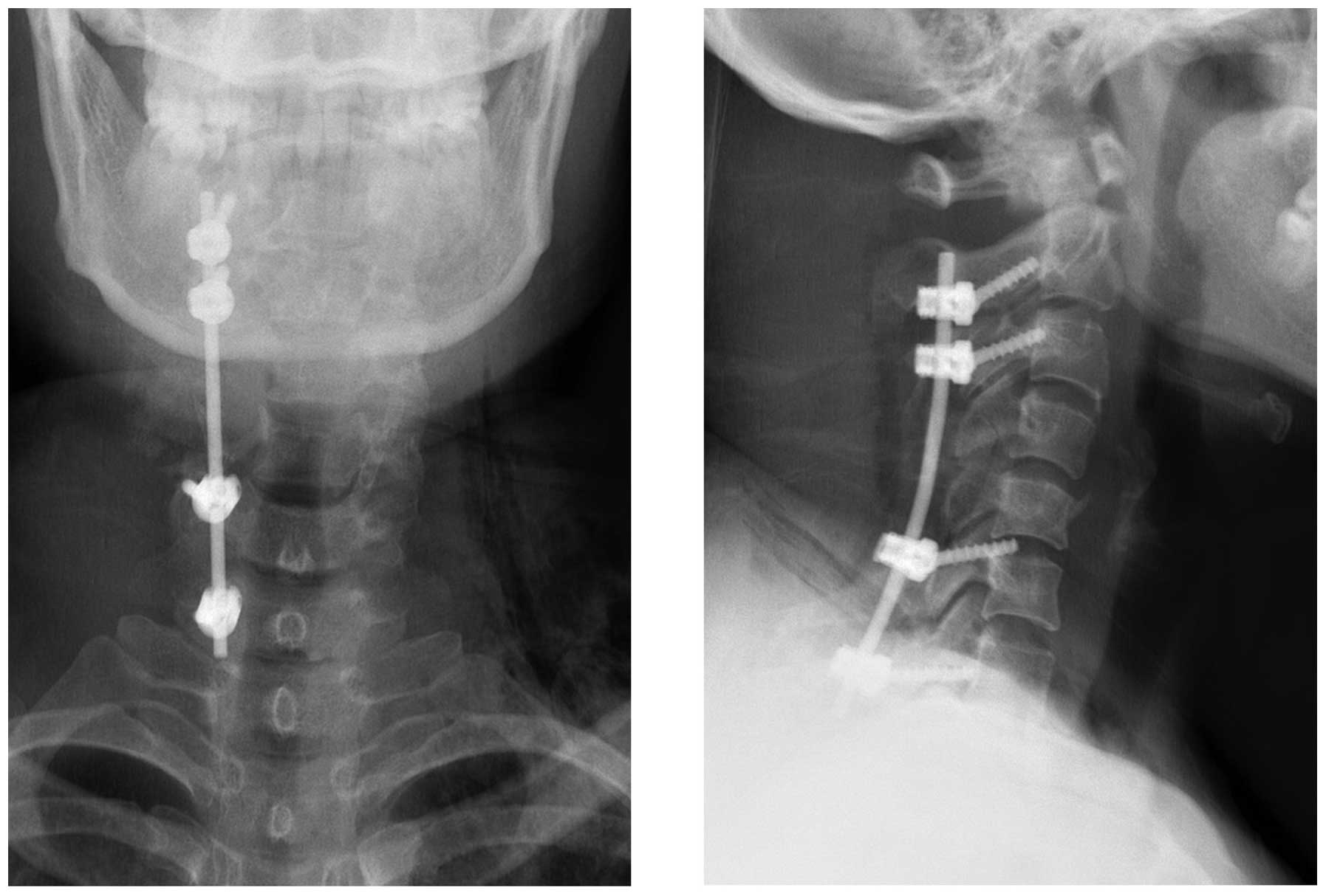 Unilateral Lateral Mass Fixation Of Cervical Spinal Low grade Unilateral Lateral Mass Fixation Of Cervical Spinal Low grade