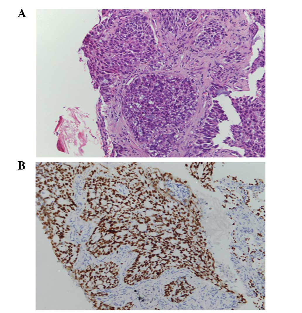 Lung adenocarcinoma harboring L858R and T790M mutations in epidermal ...
