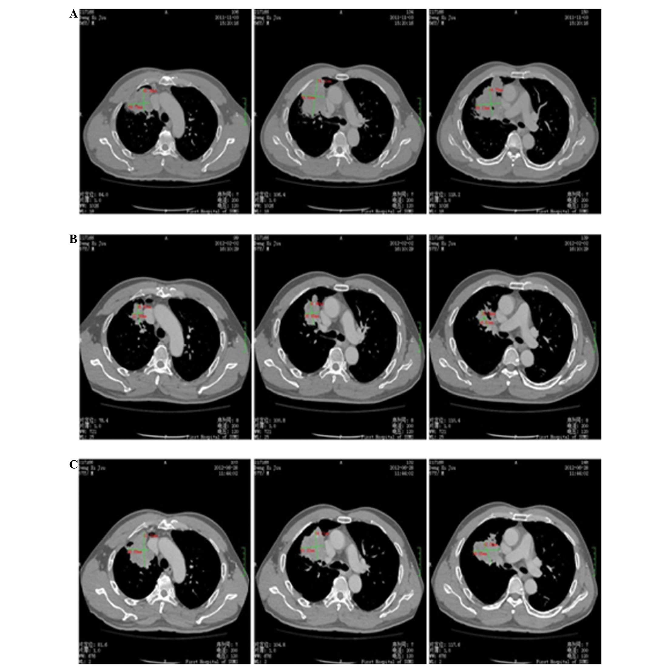 Lung adenocarcinoma harboring L858R and T790M mutations in epidermal ...