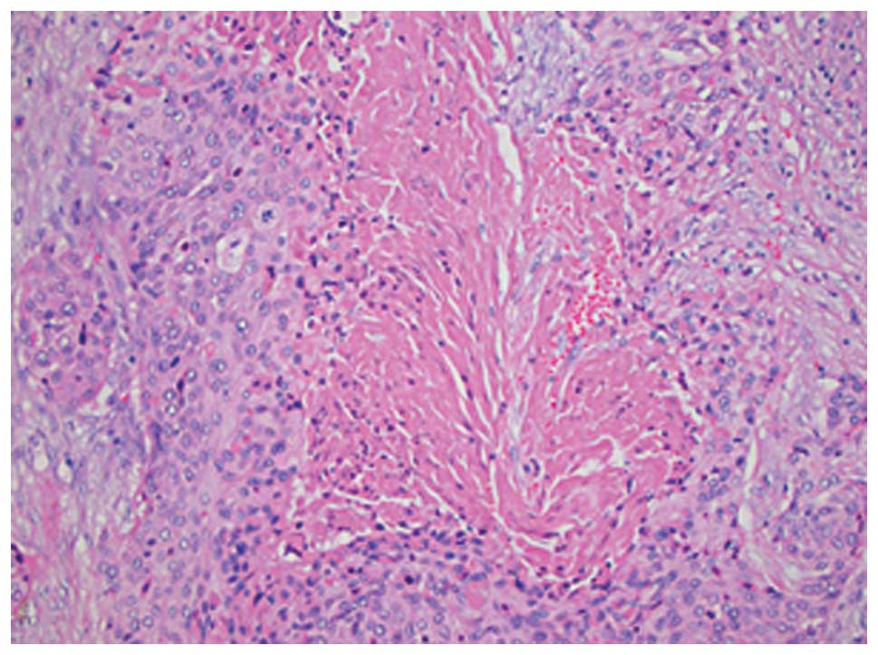 Pure Primary Ovarian Squamous Cell Carcinoma A Case Report And Review